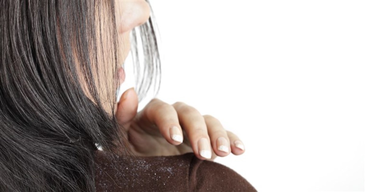 5 Home Remedies To Discard The Disgusting Dandruff
