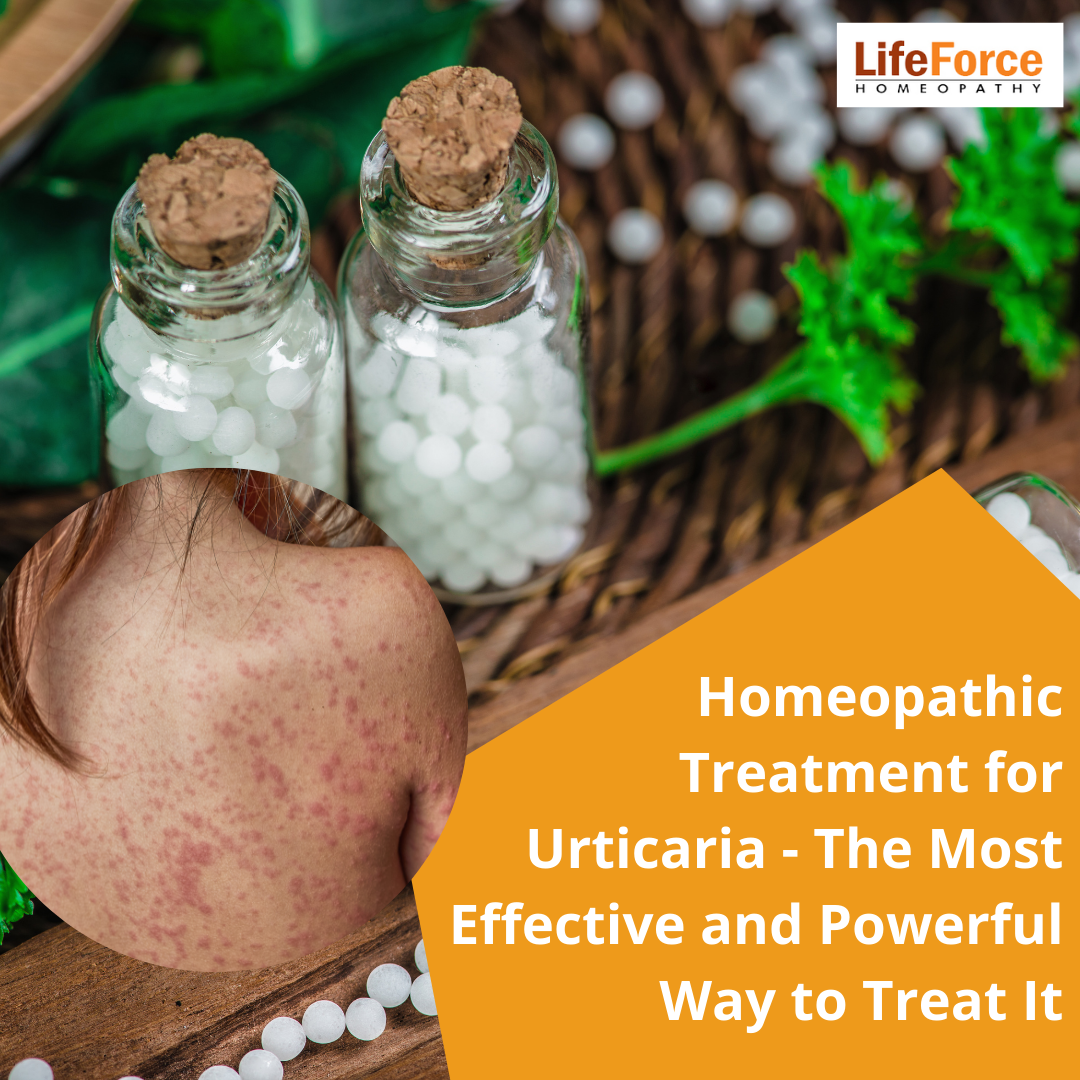 Urticaria Treatment with Homeopathy: Safe and Effective | Blog