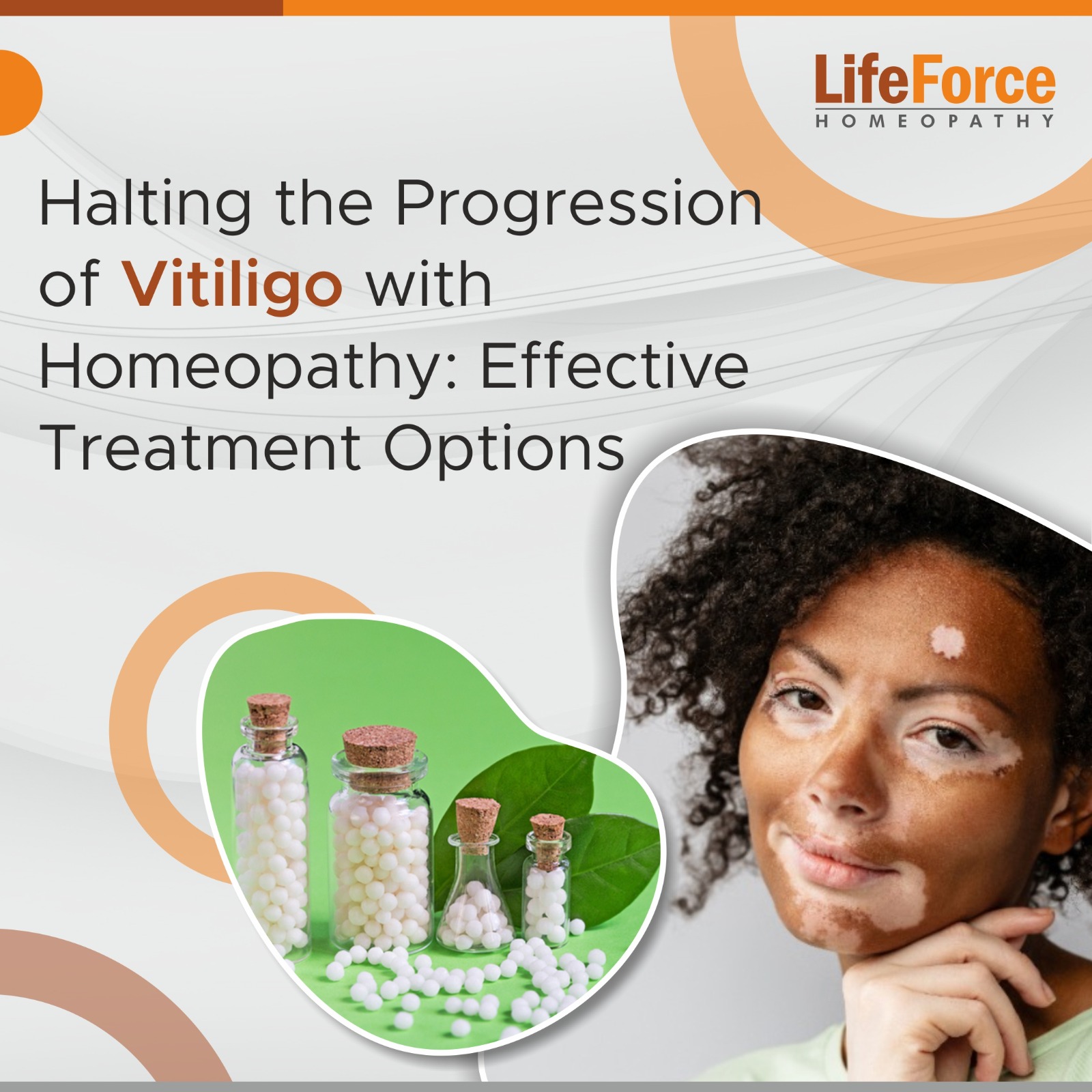 Vitiligo Blog | Halting Progression with Homeopathy | Life Force