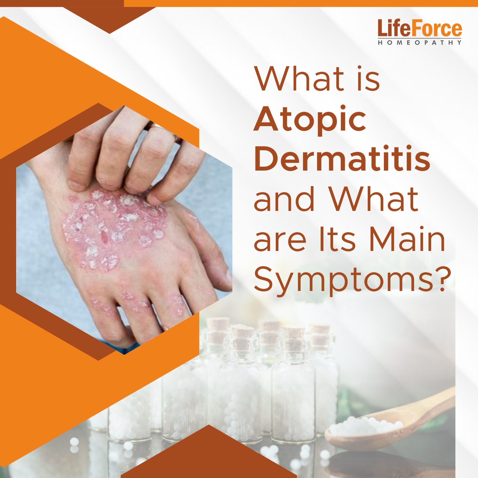 Atopic Dermatitis | Causes, Symptoms, and Homeopathic Care